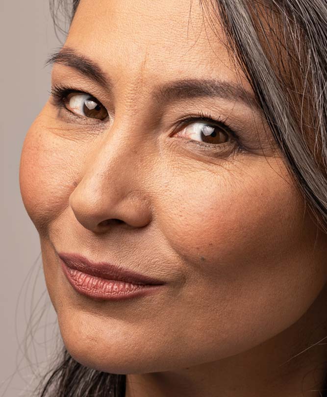 Crow's Feet | Refresh Medispa | Amersham